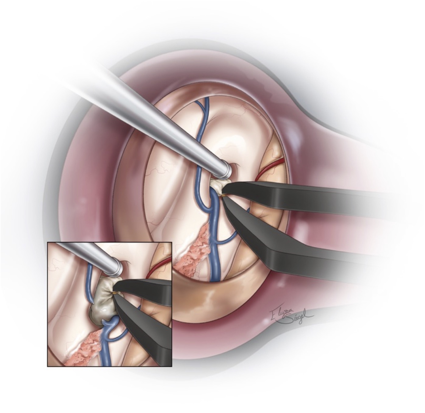 Transcortical Approach For Resection Of A Colloid Cyst And Fenestration Transcortical Approach For Resection Of A Colloid Cyst And Fenestration