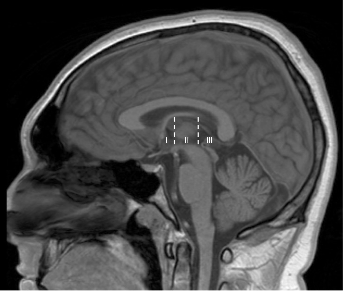 Transcortical Approach For Resection Of A Colloid Cyst And Fenestration