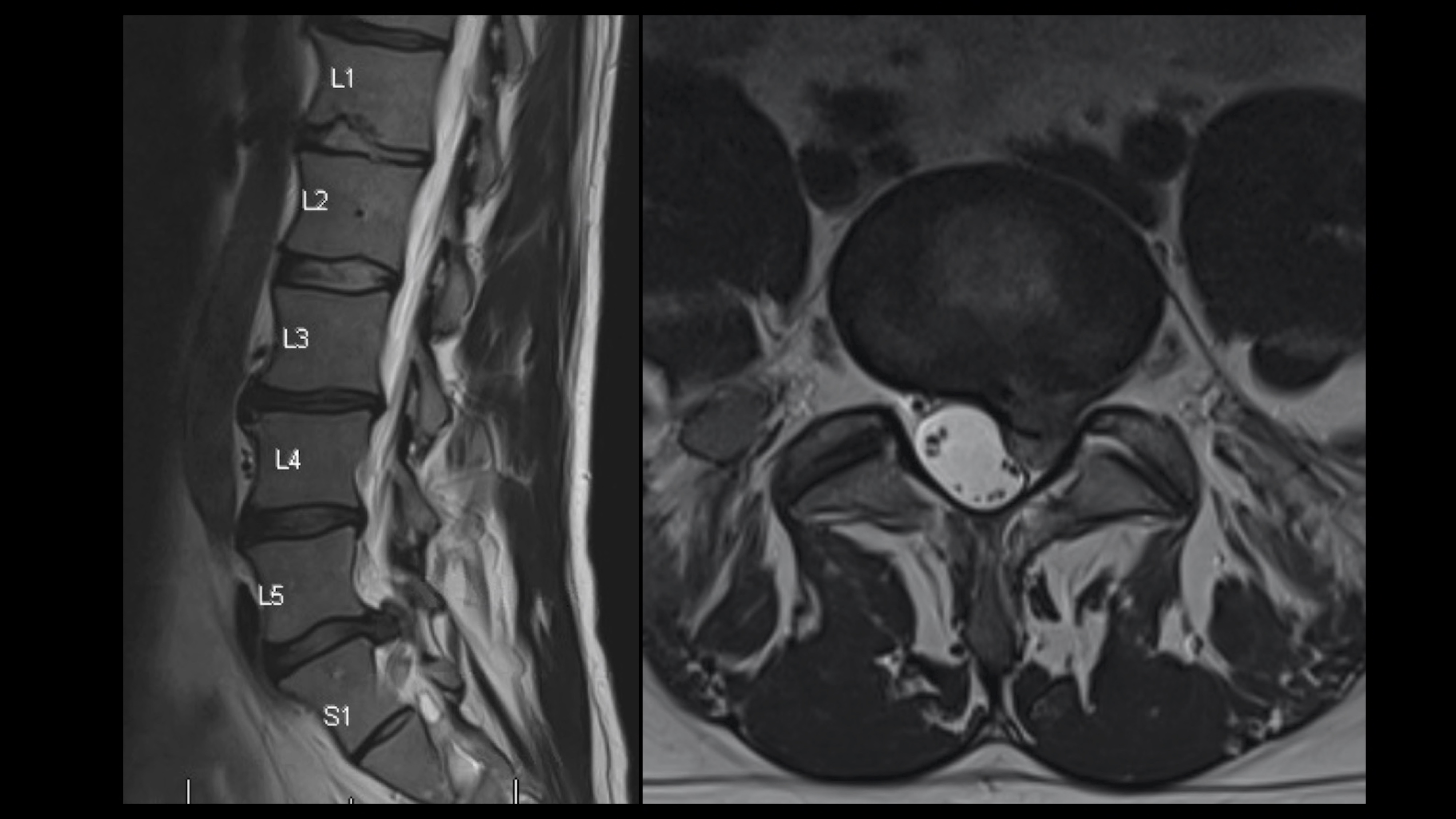 Bulging Disc L5 S1 Epidural