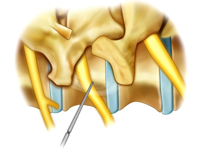 Transforaminal Ligament