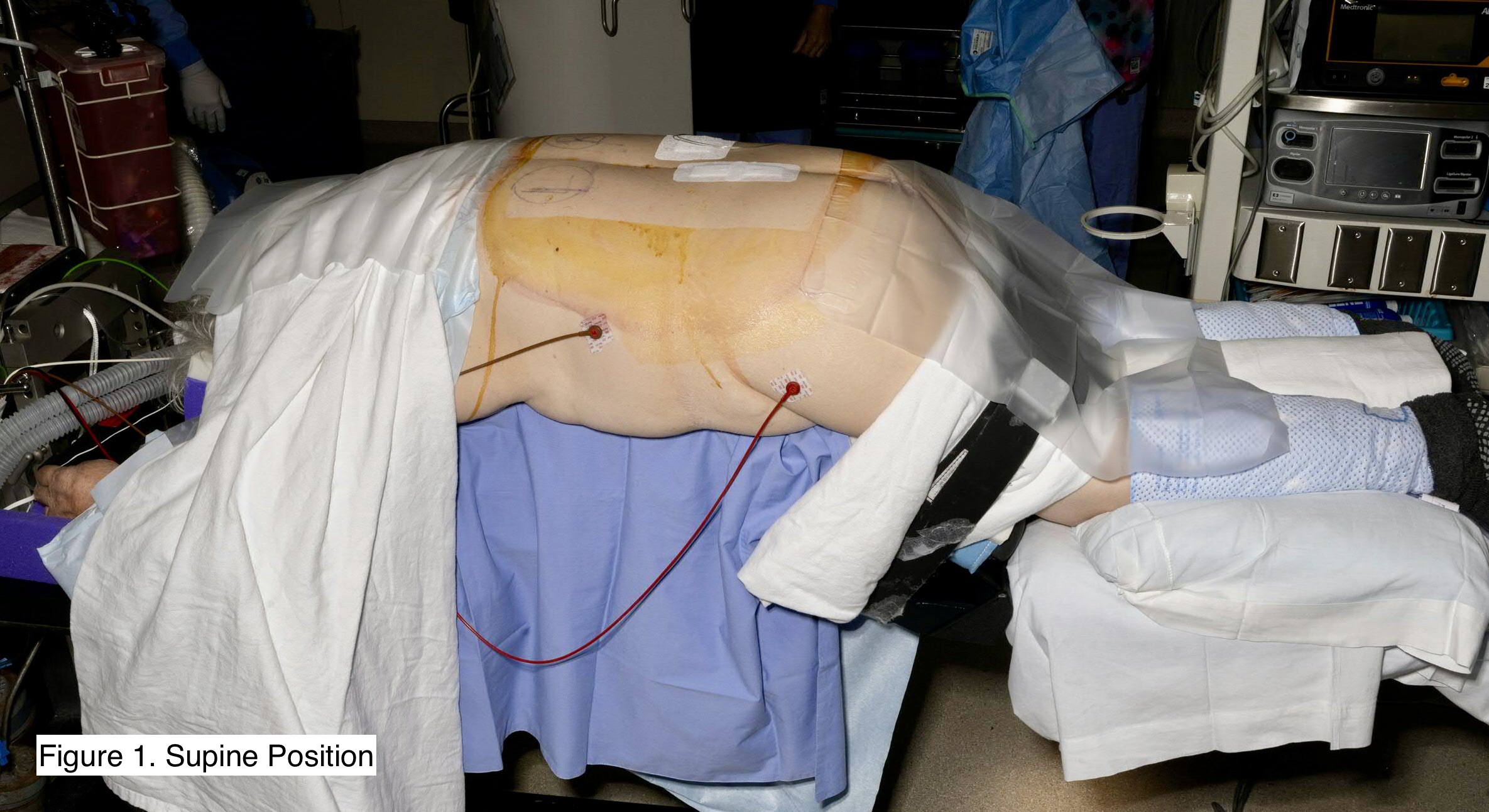 Dorsal Root Ganglion Stimulation