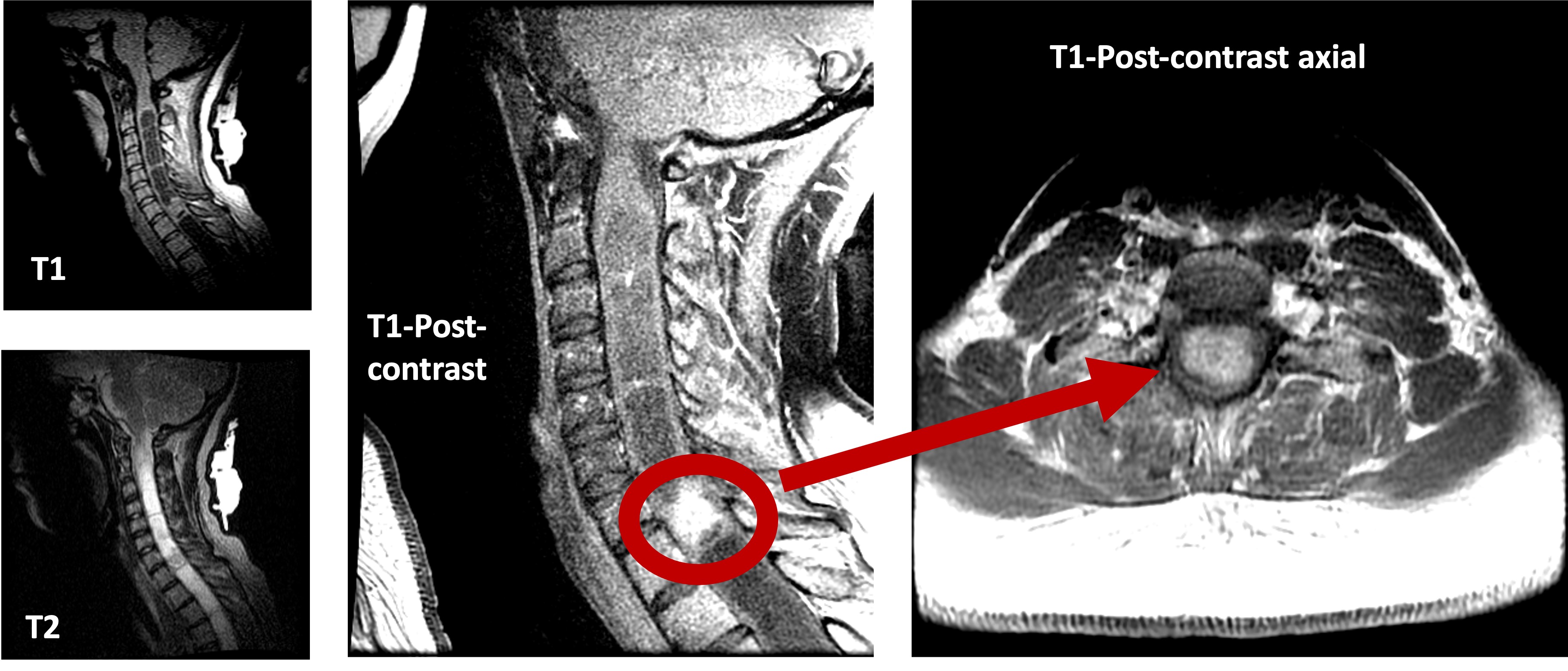 Cervical Spine Mri Without Contrast