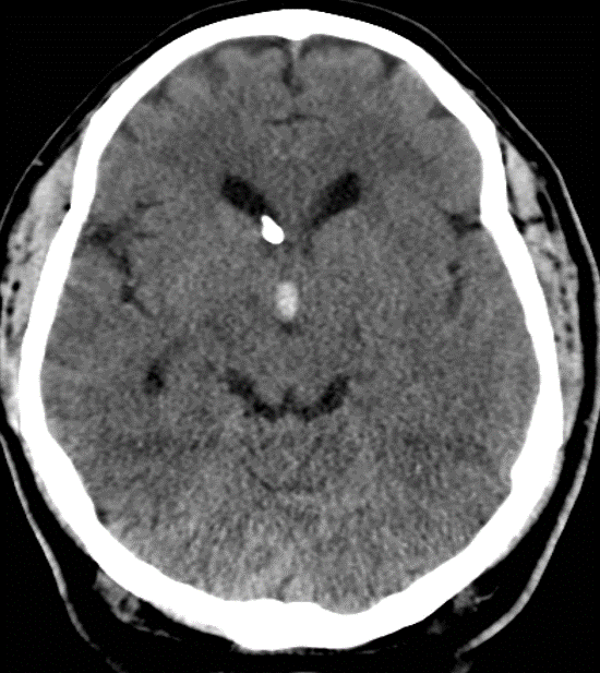 Intraventricular Hemorrhage Ct