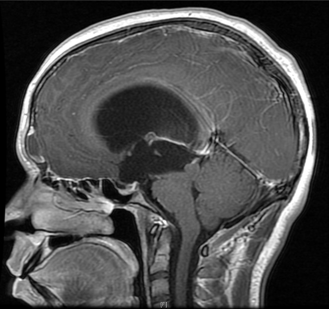 Endoscopic Third Ventriculostomy For The Treatment Of Obstructive