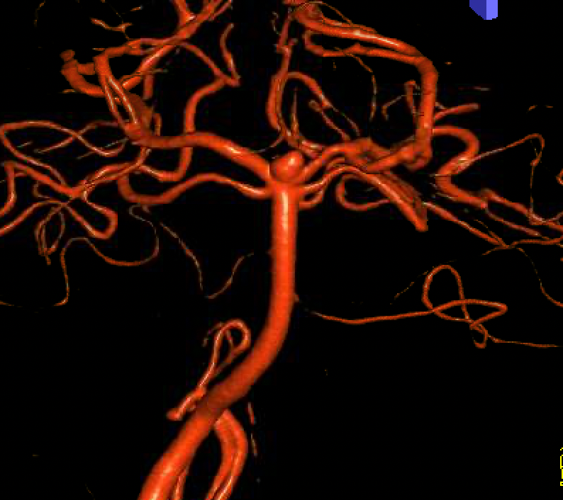 Basilar Artery Aneurysm Treatment