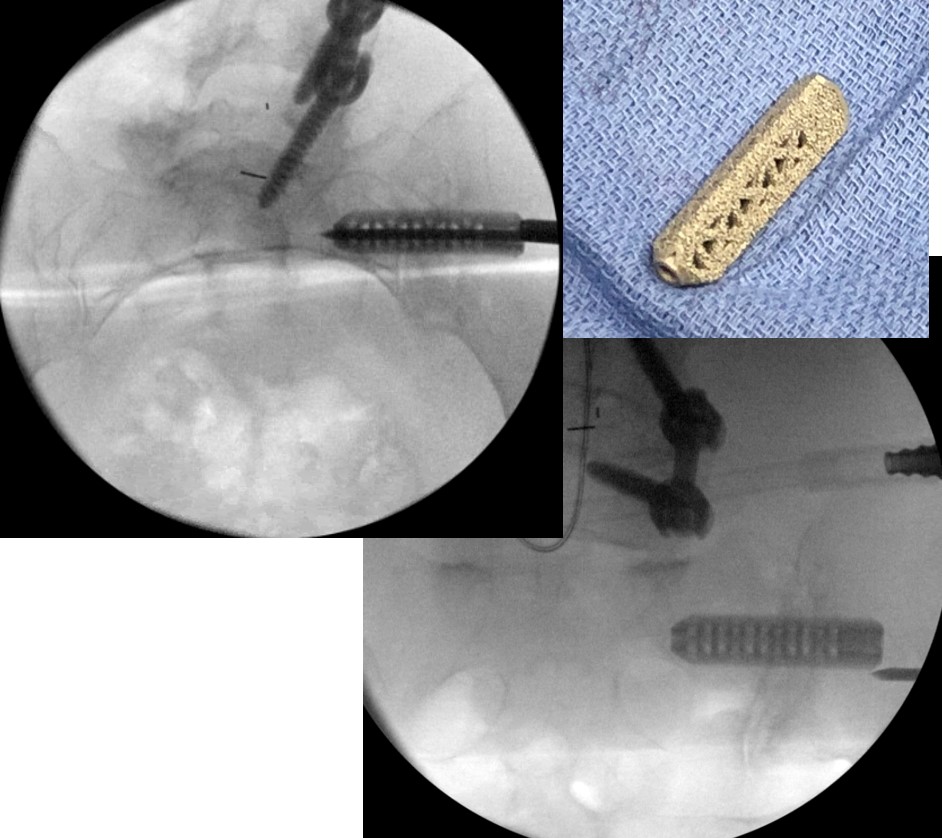 Sacroiliac Si Joint Fusion For Sacroiliac Degenerative Disease