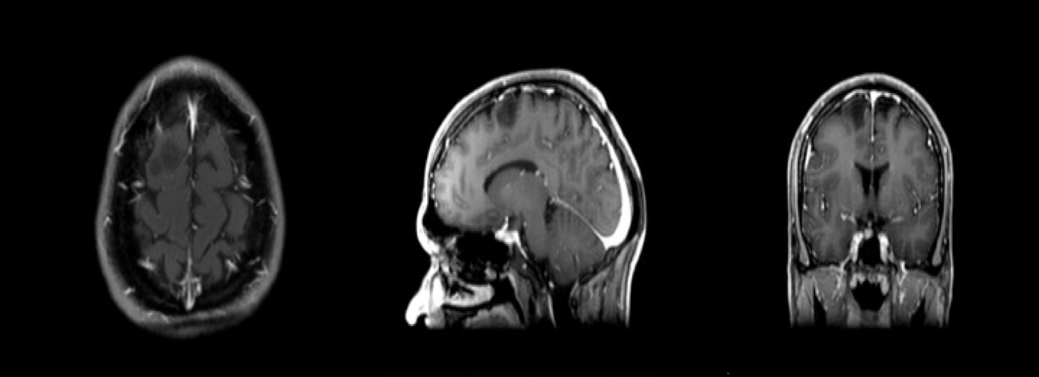 Mri Paracentral Lobule