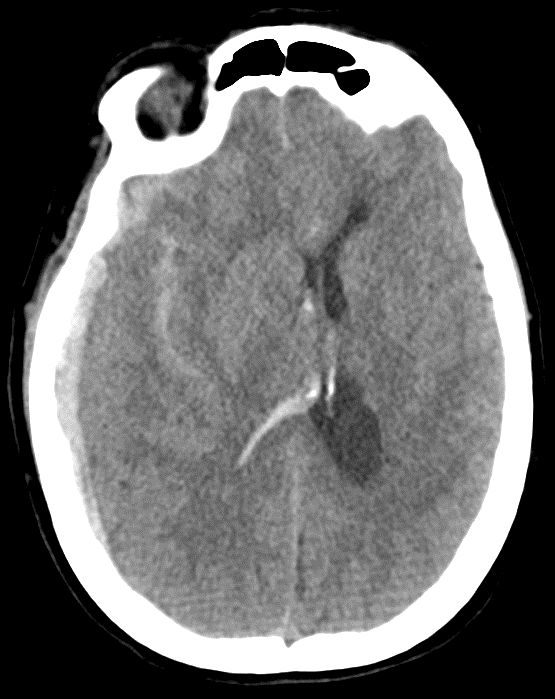 Posterior Communicating Artery Aneurysm Neurointervention