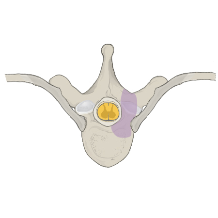 Thoracic Vertebrae Unlabeled Transpedicular Approach For Resection Of