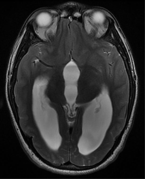 Endoscopic Third Ventriculostomy For The Treatment Of Obstructive