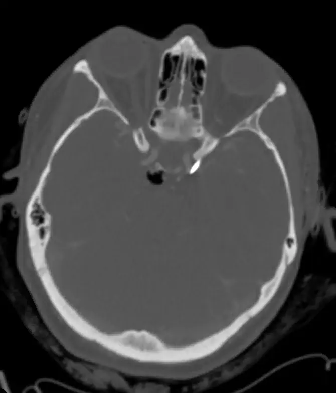 Lateral Supraorbital Craniotomy For Left Pcom Aneurysm With Oculomotor